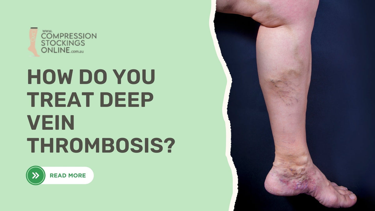 How Do You Treat Deep Vein Thrombosis?– Compression Stockings Online