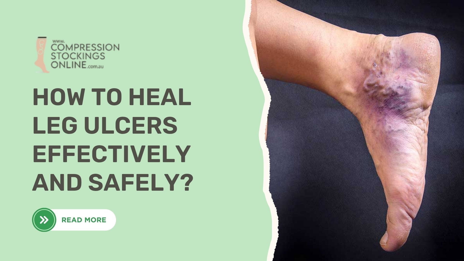 How to Heal Leg Ulcers Effectively and Safely? – Compression Stockings ...